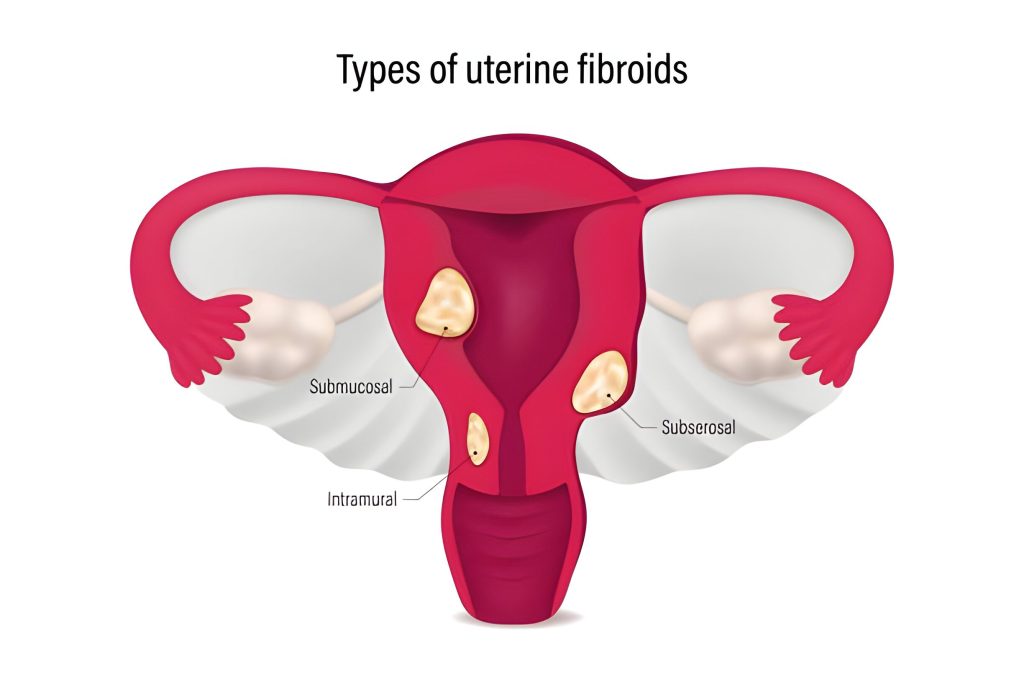 What is Intramural Fibroid? Causes, Symptoms & Treatment