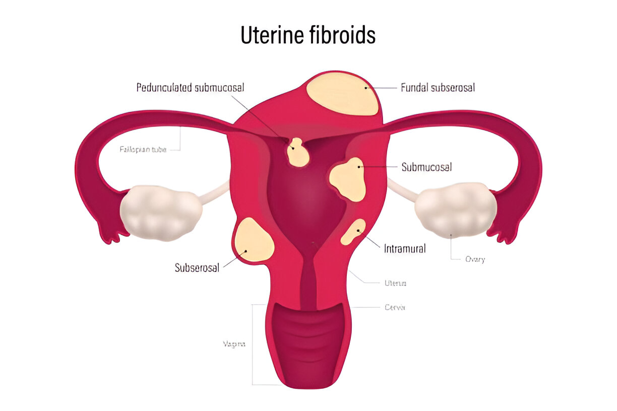 Submucosal Fibroid: Types, Symptoms, and Treatment Options